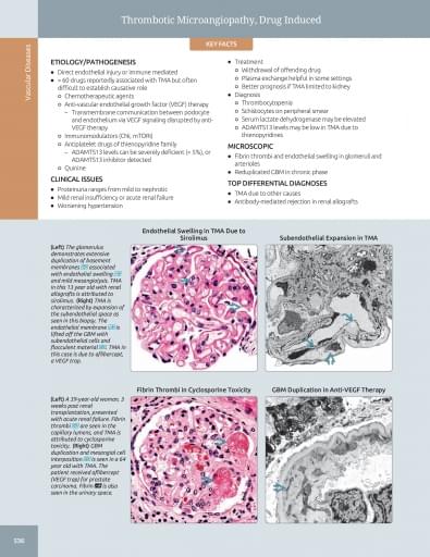 Thrombotic Microangiopathy, Drug Induced - Universidad...